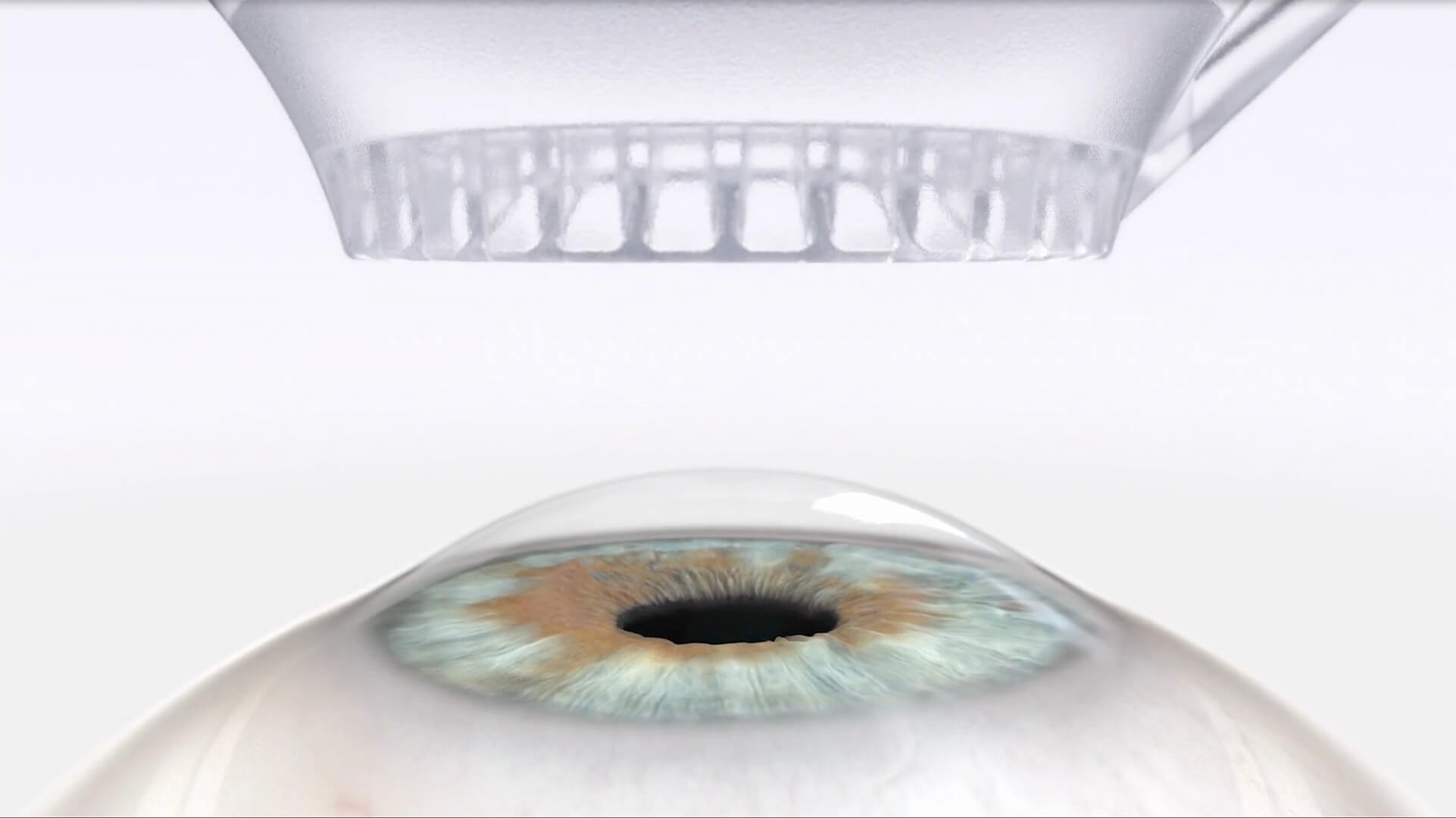 LASIK vs. EVO ICL: Which Vision Surgery Is Right for You? (Celebrities ...